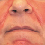 Top Natural Homeopathic Remedies for Photodermatitis - Homeopathy at ...