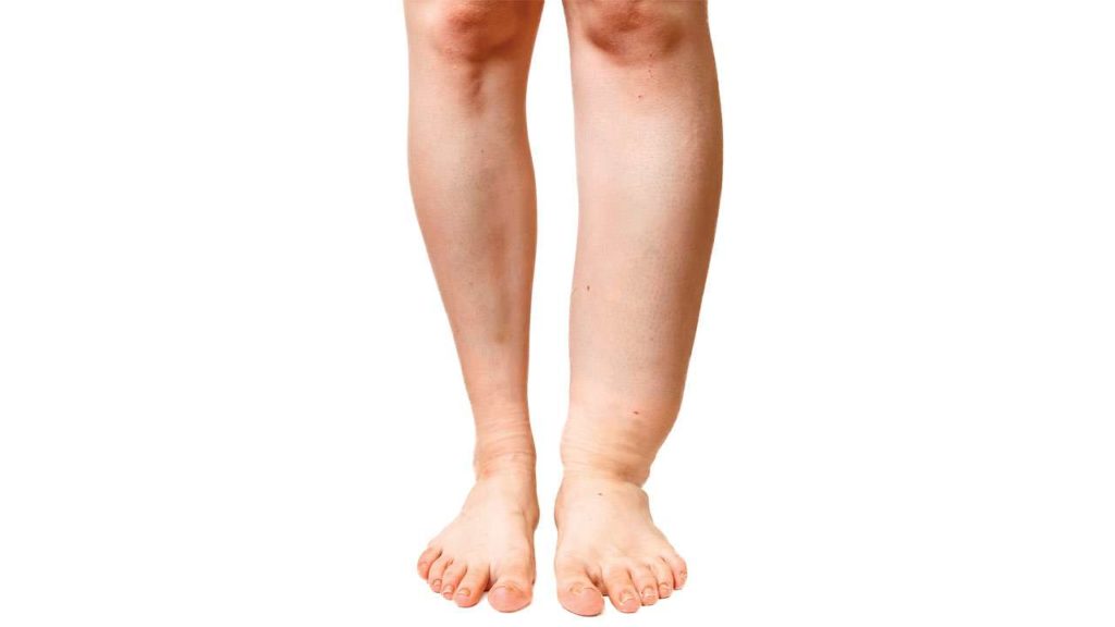 Homeopathic Medicines for Filariasis - DrHomeo Homeopathy