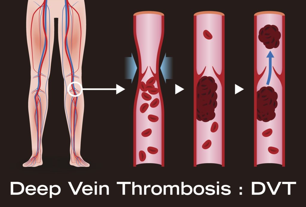 Best 6 Homeopathic Medicines For Deep Vein Thrombosis (DVT), Its Causes ...