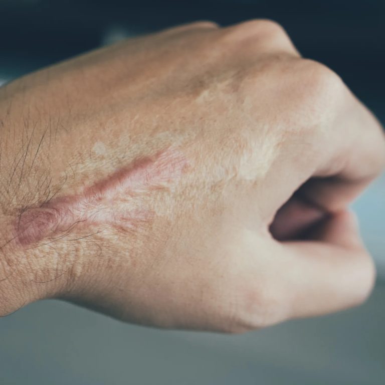 Fluoric Acid: Homeopathic Medicine – Its Use, Indications and Dosage ...