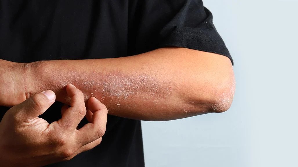 Causes of Scaly Skin and its Top 7 Homeopathic Remedies - Homeopathy at ...